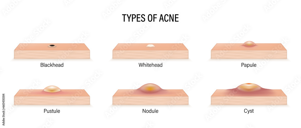Types of acne. Skincare problems and inflammation. Blackheads ...