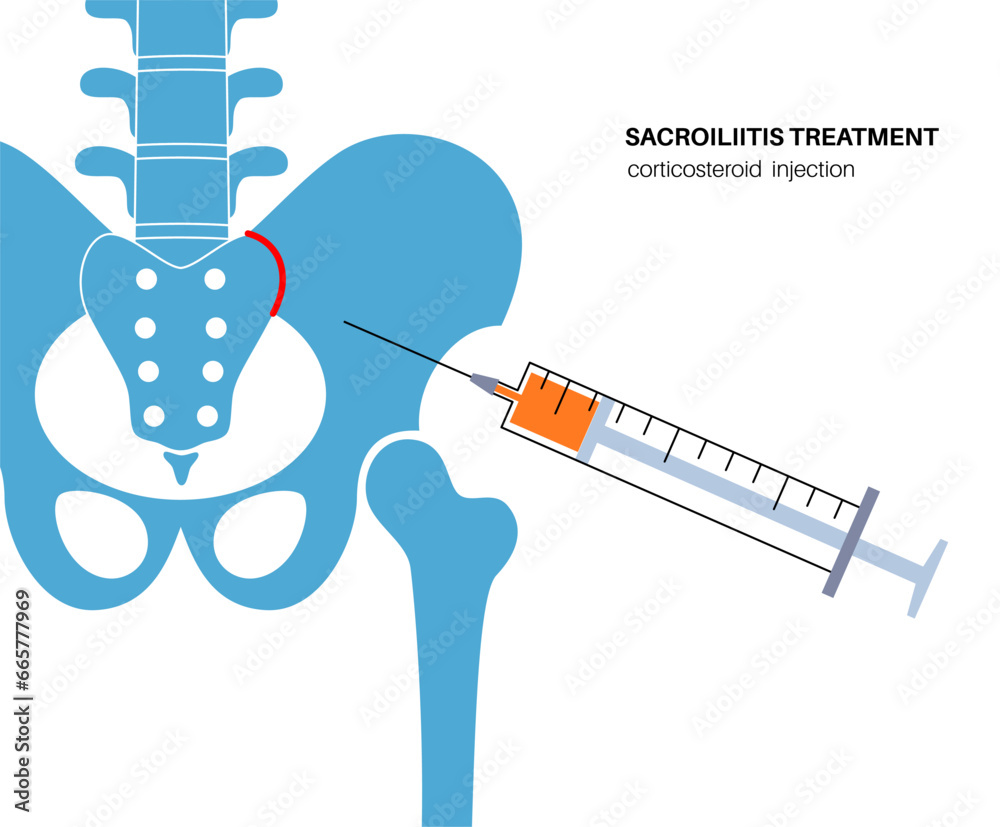 Sacroiliitis corticosteroid injections Stock Vector | Adobe Stock