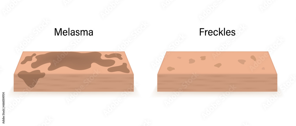The difference between skin with melasma and skin with freckles. Human ...