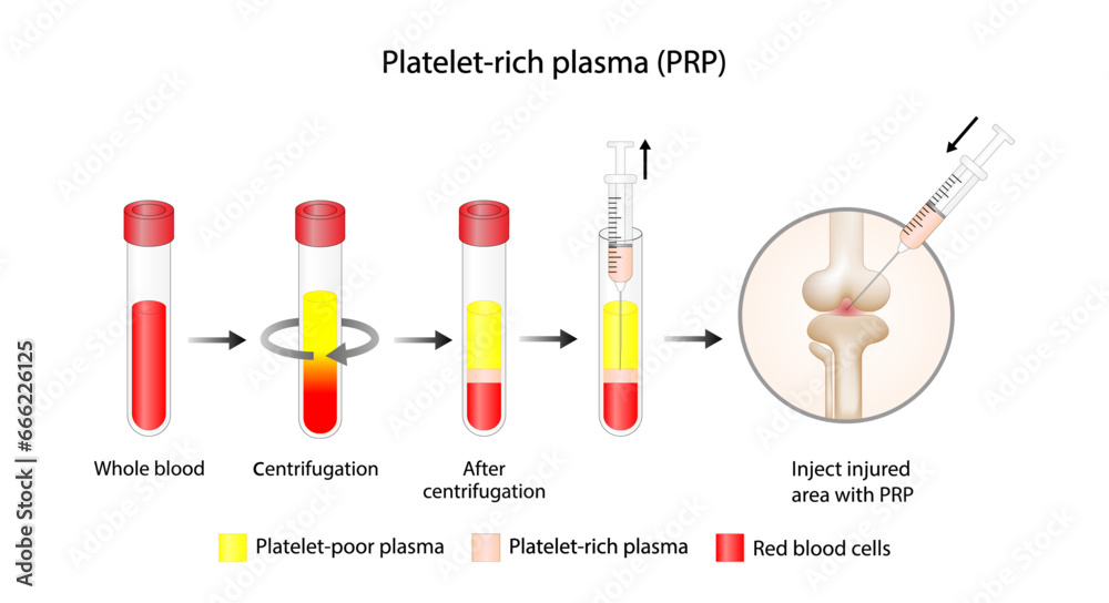 Platelet-rich plasma (prp). Autologous conditioned plasma, is a ...