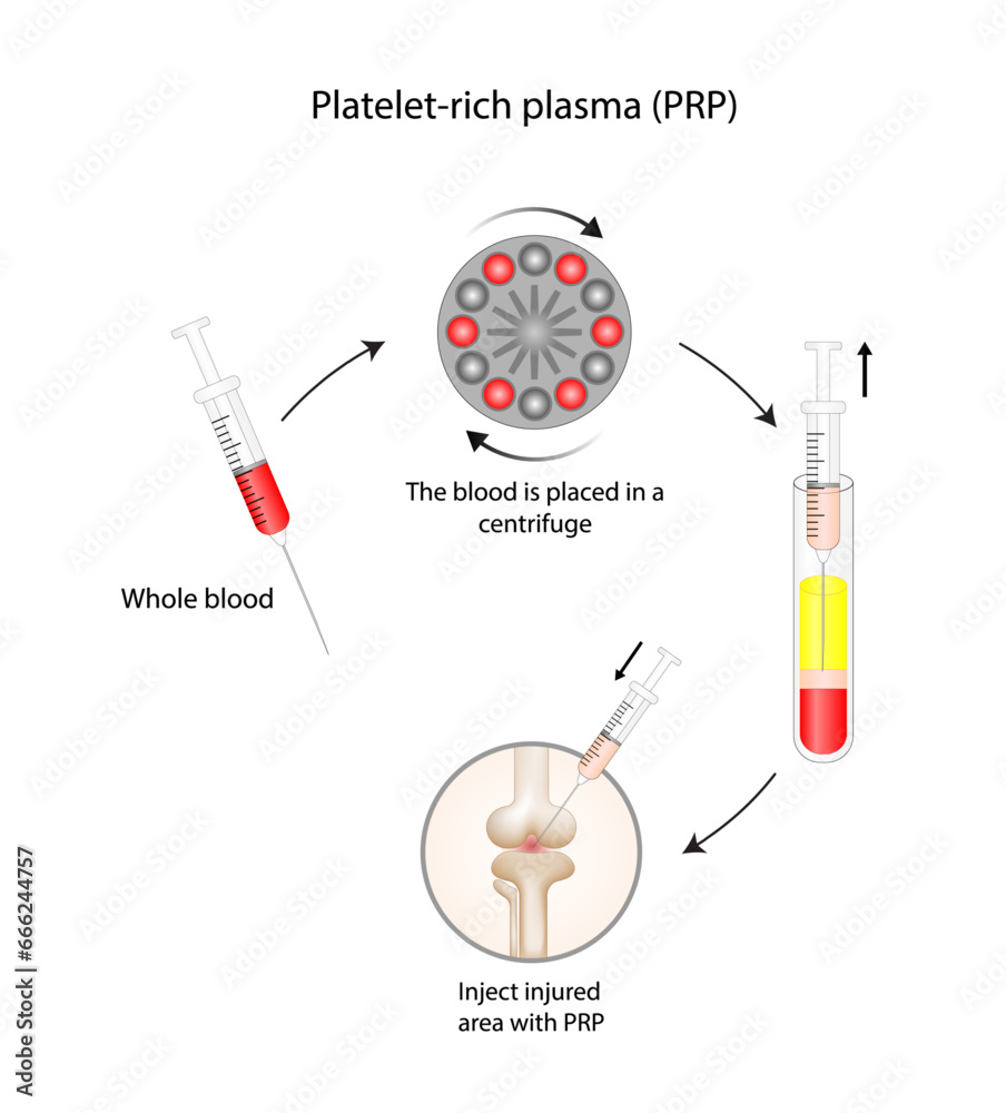 Platelet-rich plasma (prp). Autologous conditioned plasma, is a ...