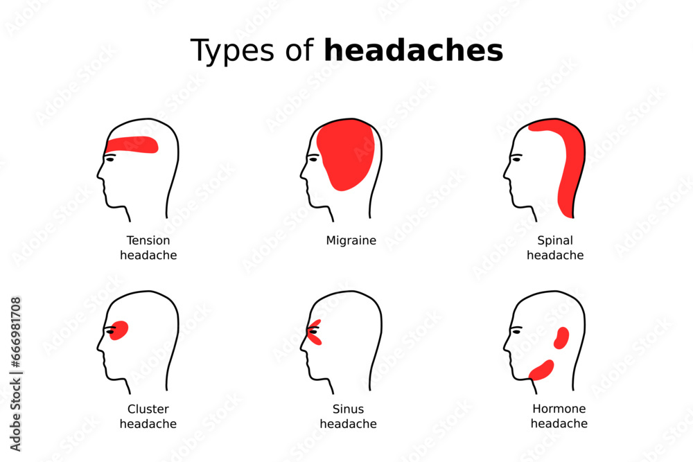 Vetor de Types of headaches vector infographic do Stock | Adobe Stock