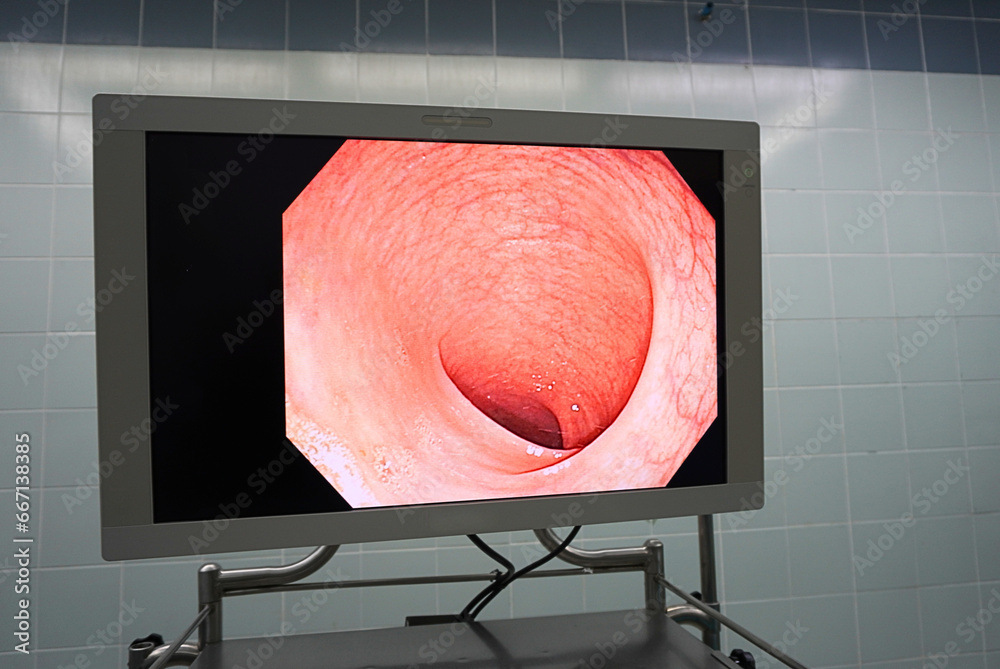Inside view of large bowel during colonoscopy for colorectal cancer ...