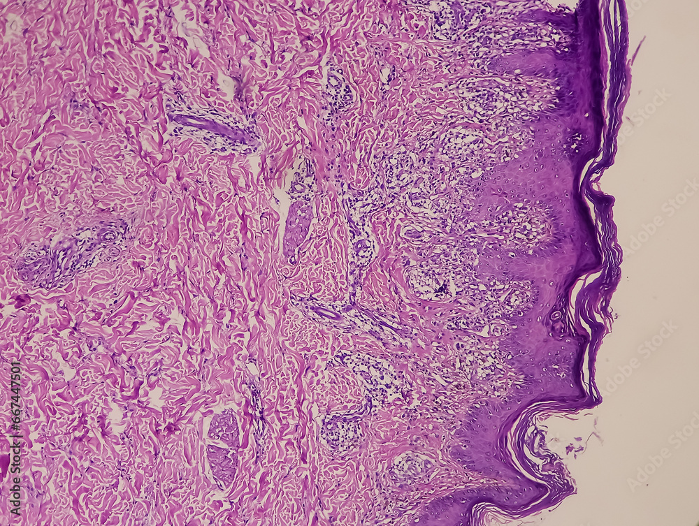 Skin tissue biopsy: Lichen planus. show skin tissue, epidermis show ...