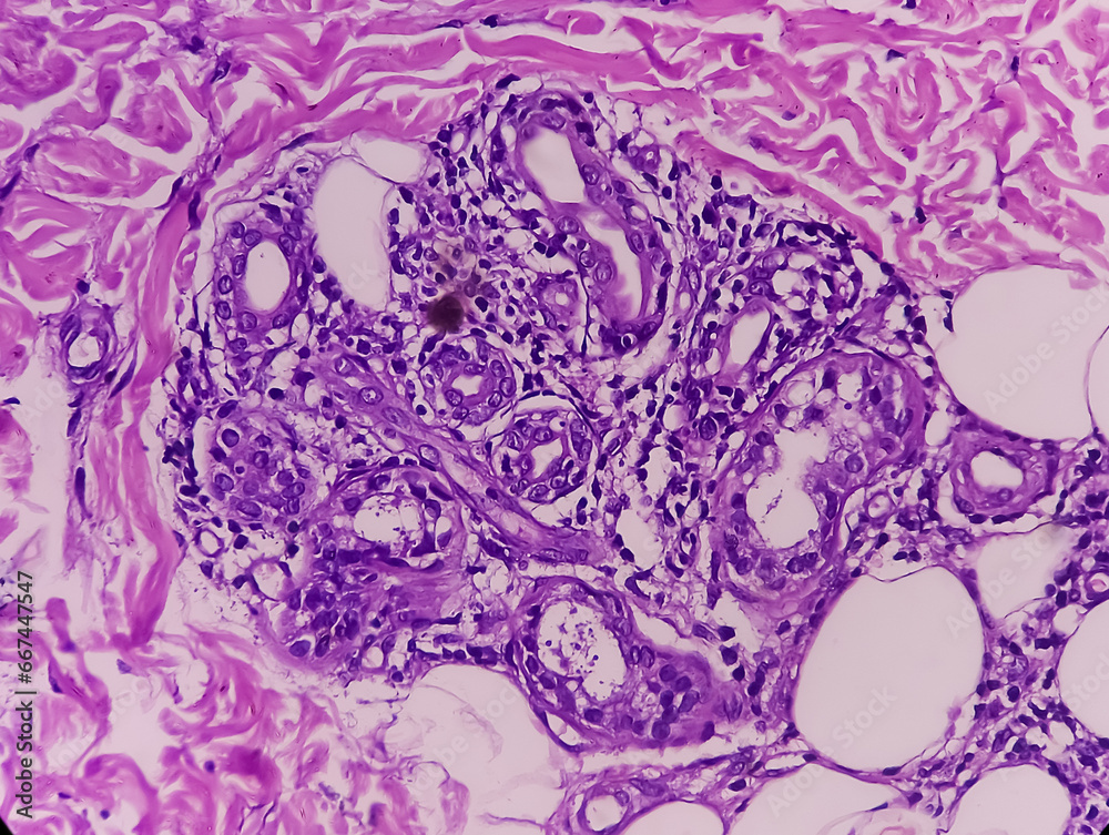 Skin tissue biopsy: Lichen planus. show skin tissue, epidermis show ...