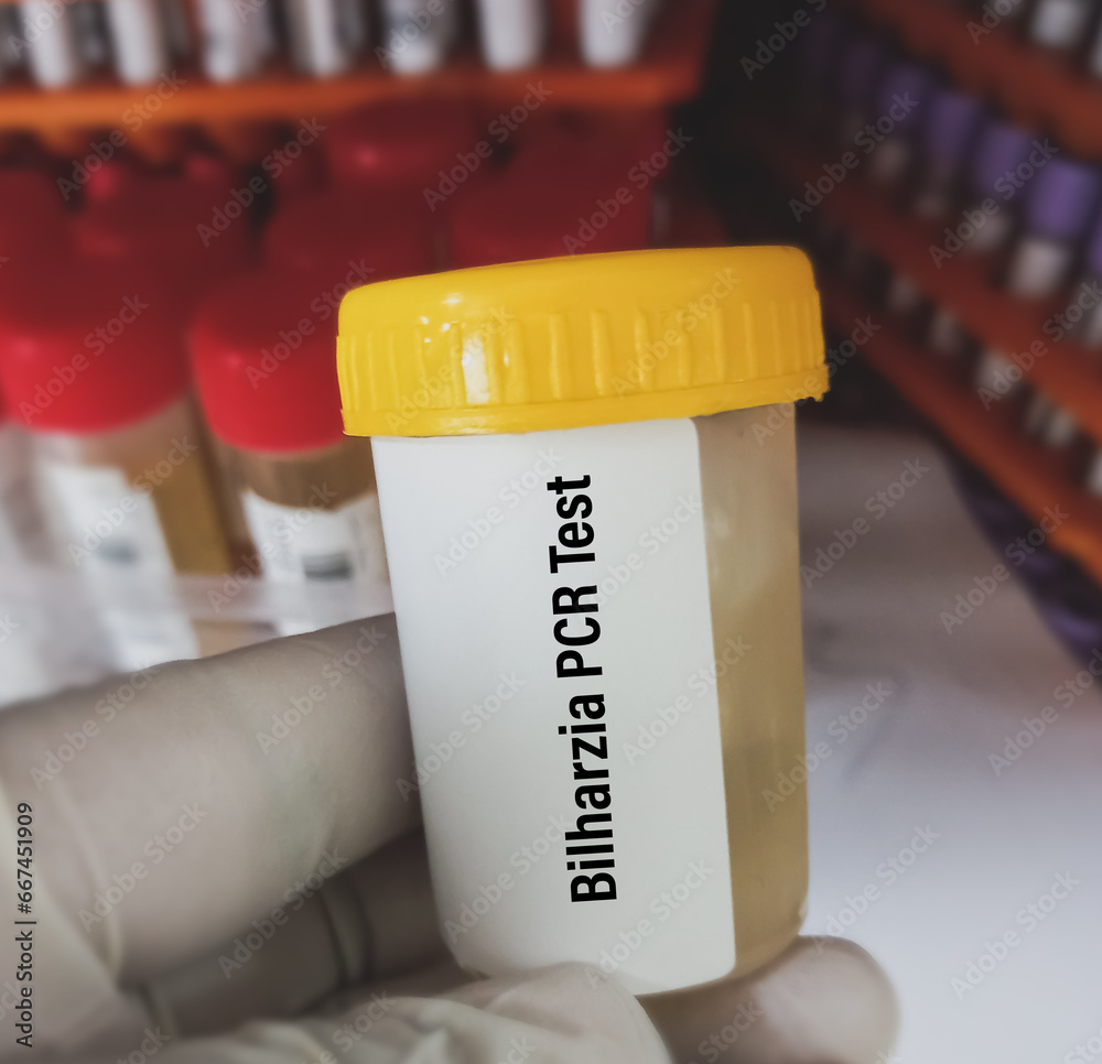 Urine sample for Real time PCR Bilharzia test to diagnosis of ...