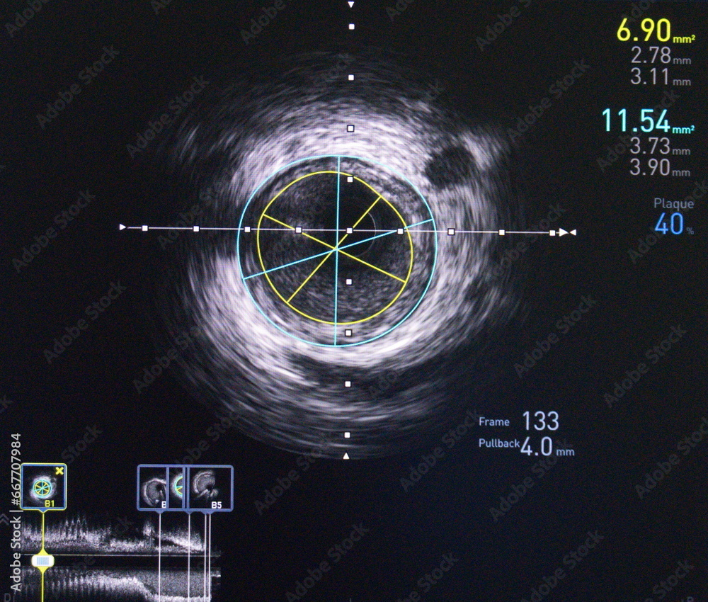 Intravascular ultrasound (IVUS) was performed measurement of coronary ...