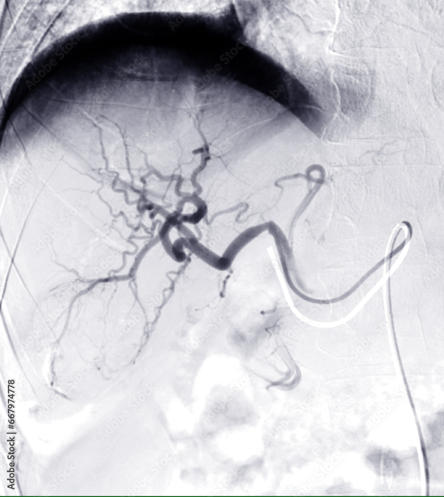 Poster Transarterial Chemoembolization (TACE) is a medical procedure ...