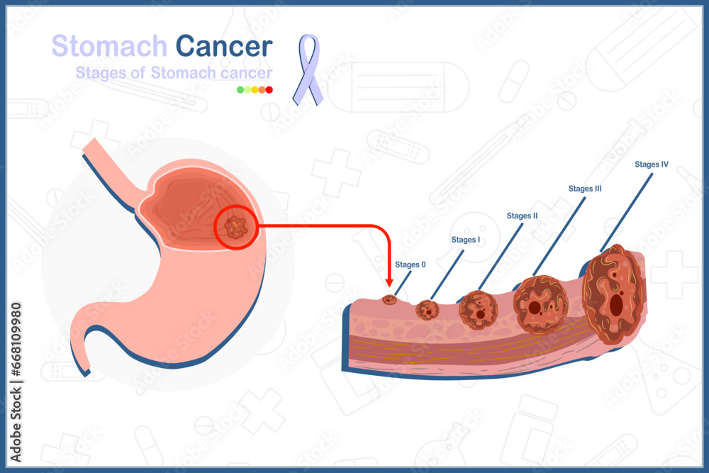 Medical vector illustration concept in flat style of stomach cancer. 5 ...