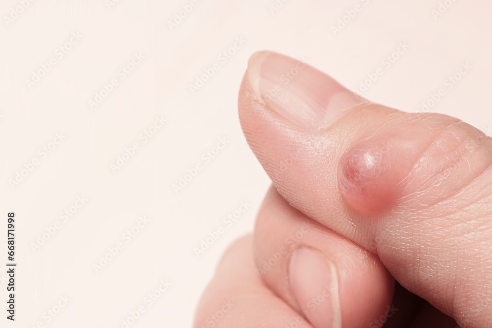 Ganglion cyst (synovial cyst disease) on the thumb of a woman’s hand ...