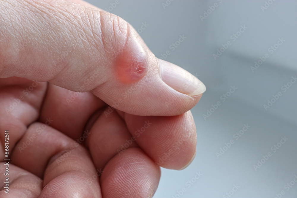Ganglion cyst (synovial cyst disease) on the thumb of a woman’s hand ...