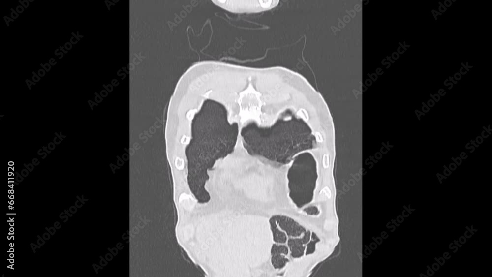 Diaphragmatic hernia or Hiatus hernia, CT scan Stock Video | Adobe Stock