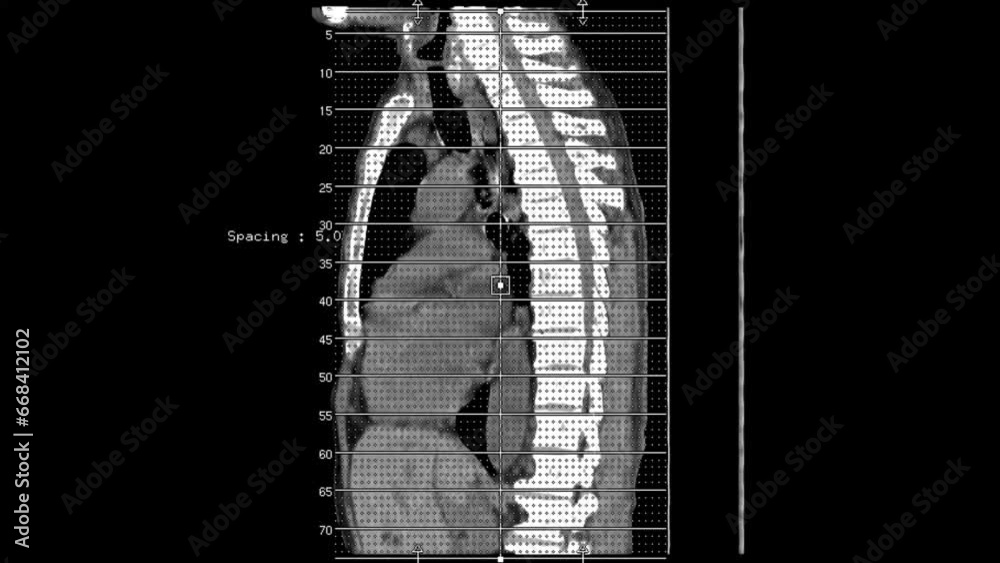 Diaphragmatic hernia or Hiatus hernia, CT scan Stock ビデオ | Adobe Stock