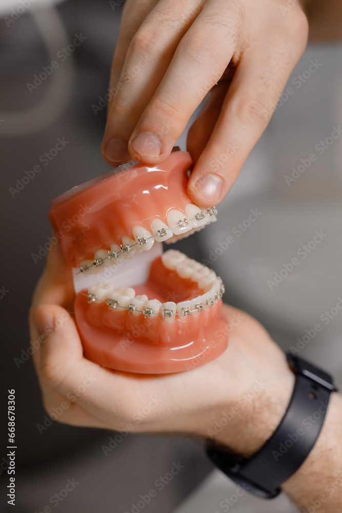Ceramic dental veneers. Close-up view of dental layout of lower row of ...