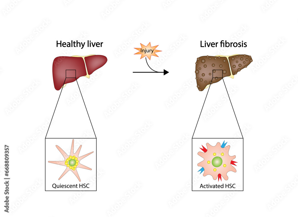 Liver fibrosis. Hepatic stellate cell, HSC. Quiescent HSC vitamin A ...