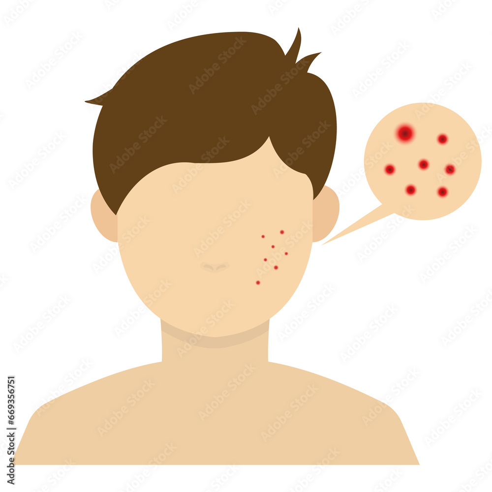 Vector illustration of pimple on cheek icon sign and symbol. colored ...