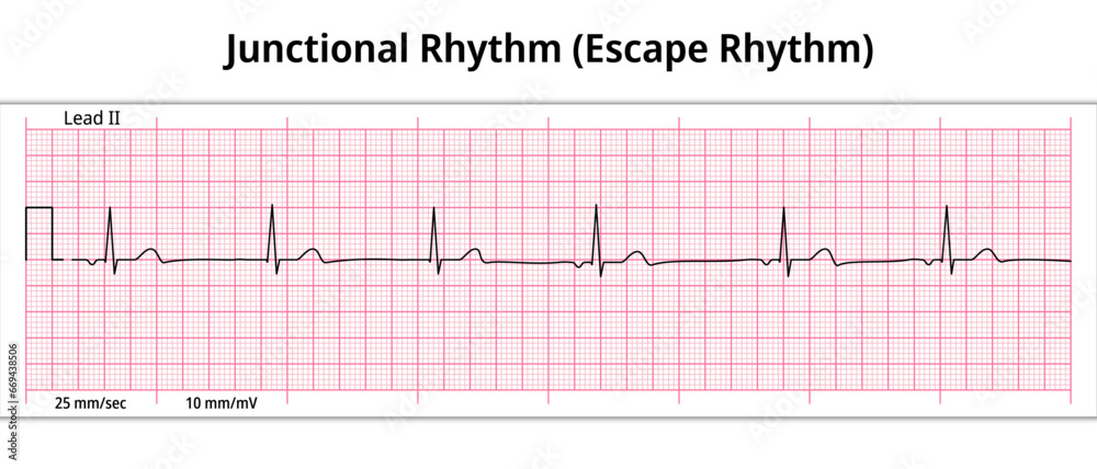 ECG Junctional Rhythm - Escape Rhythm - 8 Second ECG Paper ...