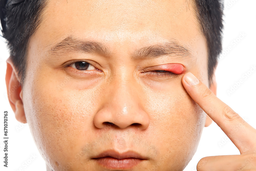 Portrait closeup of young Asian man with brown eyes with stye infection ...