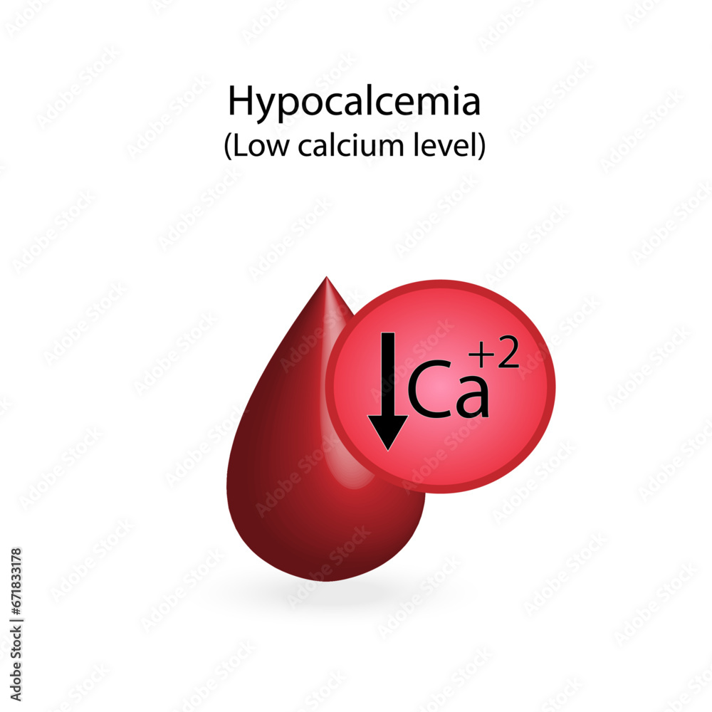 Hypocalcemia, low plasma calcium level. Calcium excess and deficit ...