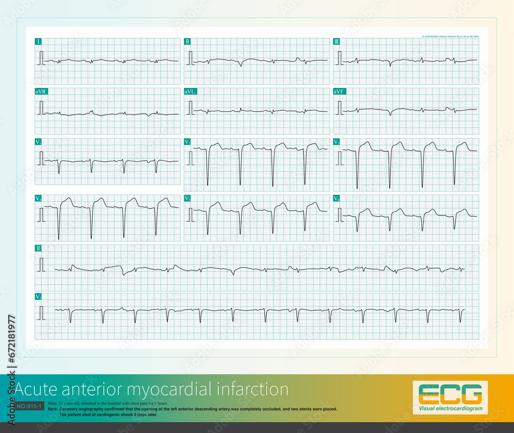 When the opening of left anterior descending artery is occluded, it can ...