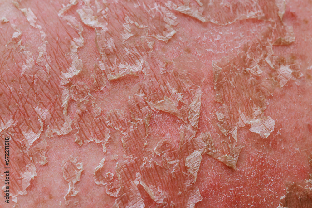 After getting sunburned human body may experience irritated reddened ...