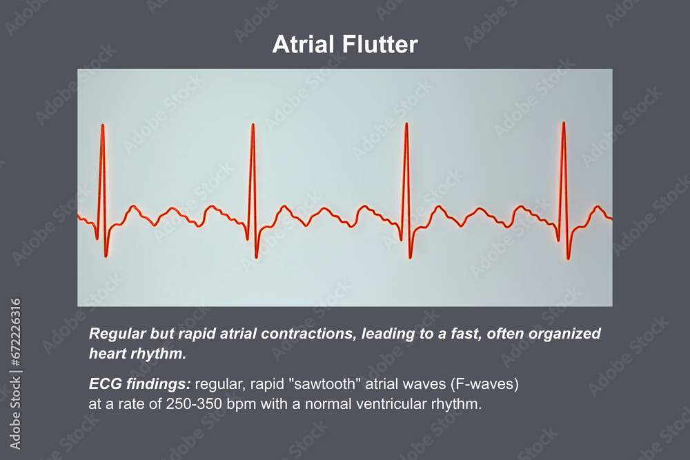 Ecg In Atrial Flutter An Abnormal Heart Rhythm Characterized By Rapid Regular Contractions Of