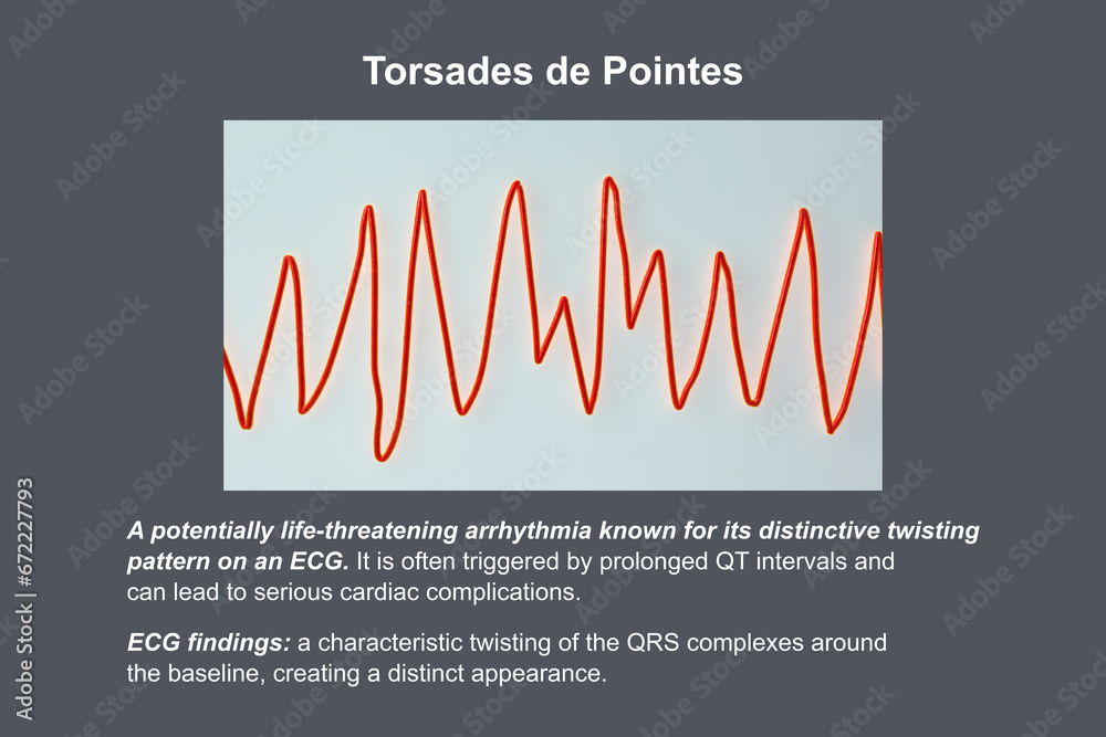 ภาพประกอบสต็อก ECG displaying Torsades de pointes rhythm, 3D ...