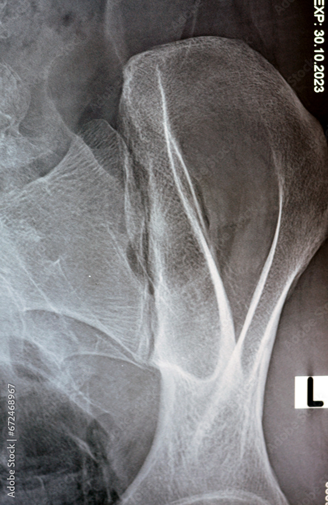 Sacroiliac joint digital radiograph examination X-ray reveals preserved ...