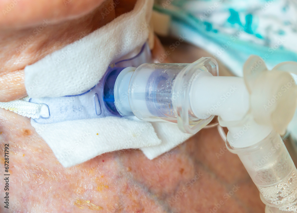 Old age woman with Alzheimer after tracheostomy operation for breathing ...