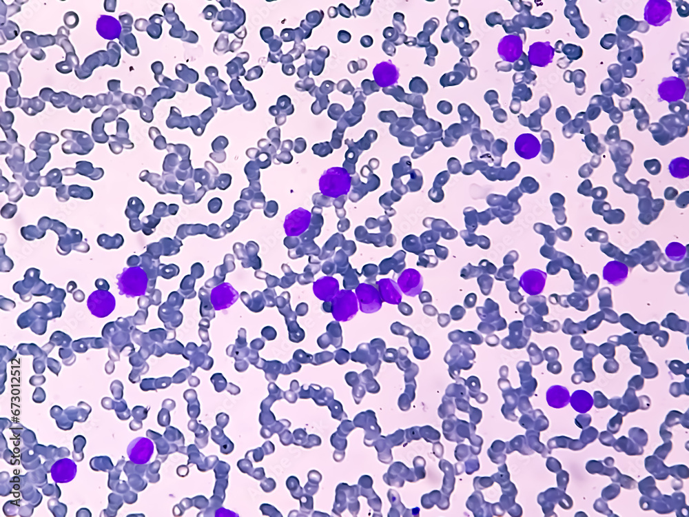 Acute myeloid leukemia (AML) is a type of blood cancer. Microscopic 10x ...