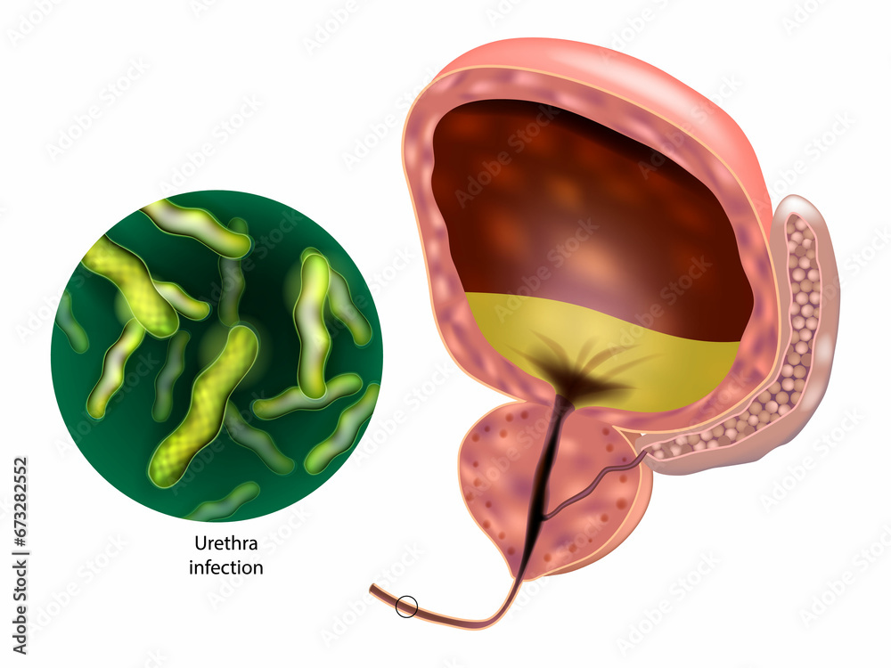 Urethritis is the inflammation of the urethra. Urinary tract infection ...