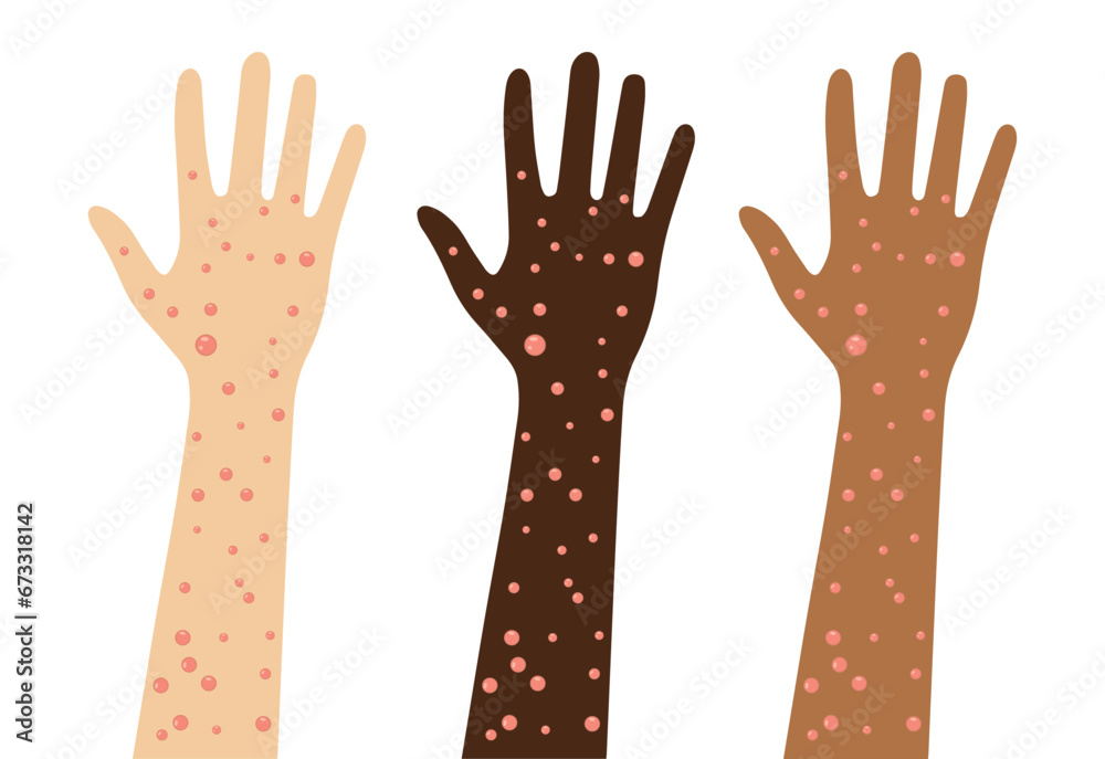 Monkey pox virus on the skin. The monkey pox virus is a viral disease ...