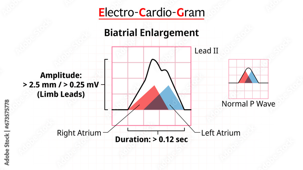 P Wave - ECG Biatrial Enlargement/Hypertrophy - Morphology P Wave - Electrocardiogram Medical ...