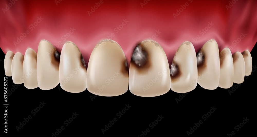 Tooth decay and calculus on teeth Caused by dense plaque in the teeth ...