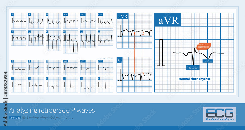 In atrioventricular reentrant tachycardia, the retrograde P-wave ...