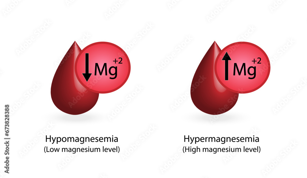 Vecteur Stock hypermagnesemia, high plasma magnesium level and ...
