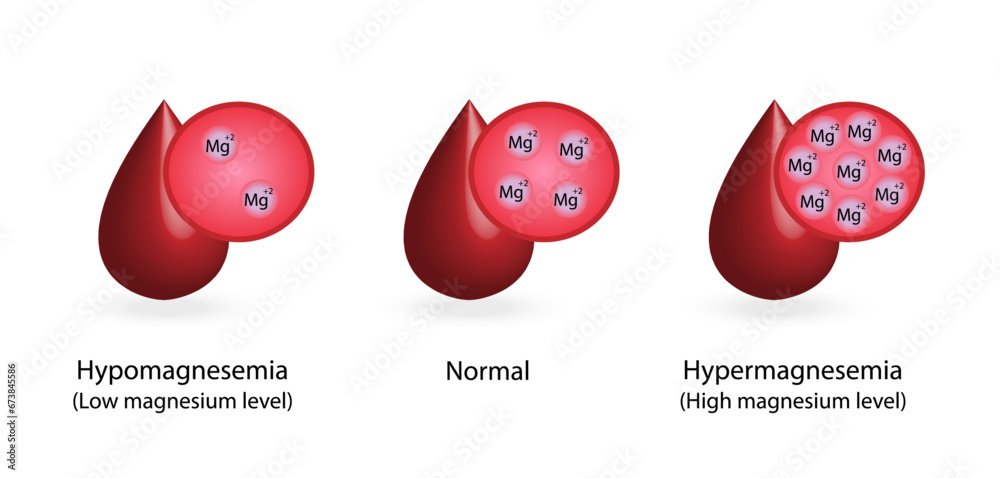 Hypermagnesemia, high plasma magnesium level and hypomagnesemia, low ...