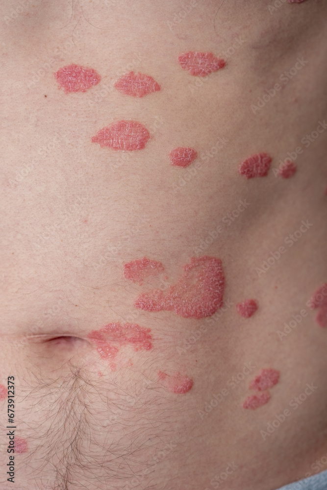 Psoriasis Vulgaris, skin patches are typically red, itchy, and scaly ...