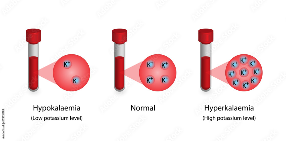 Hyperkalaemia, high plasma potassium level and Hypokalaemia, low plasma ...