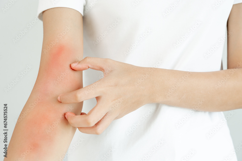 skin problem and beauty. Young woman scratch body has itchy skin from ...
