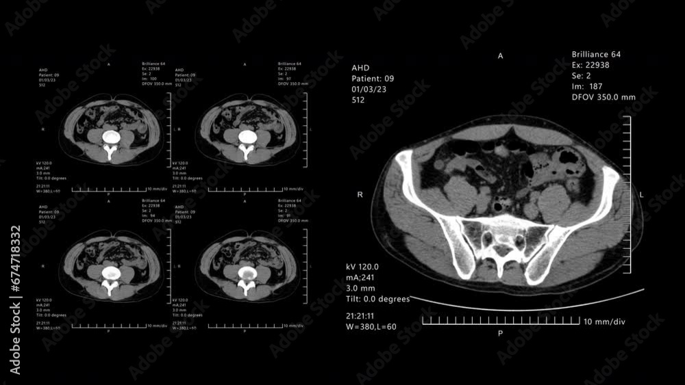 CT scan. MRI x ray Scan.Medical HUD Analyzing abdominal appendicitis ...