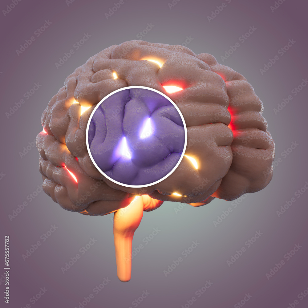 Memory lapses, forgetting things, degenerative disease. Brain problems ...