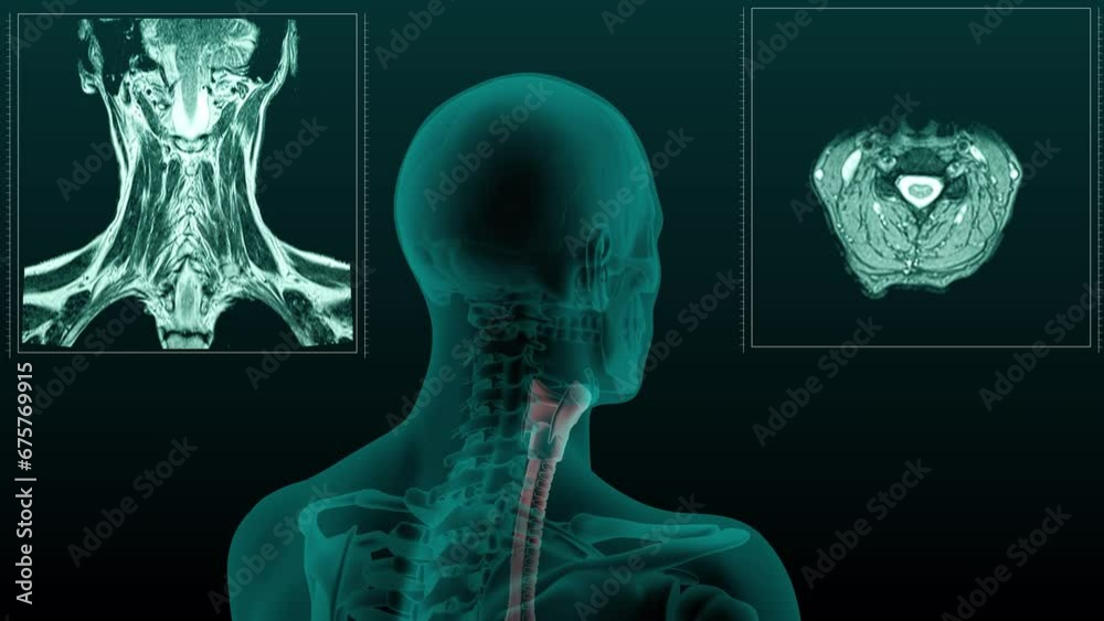 Vidéo Stock MRI scan of the human head and neck with the trachea and ...