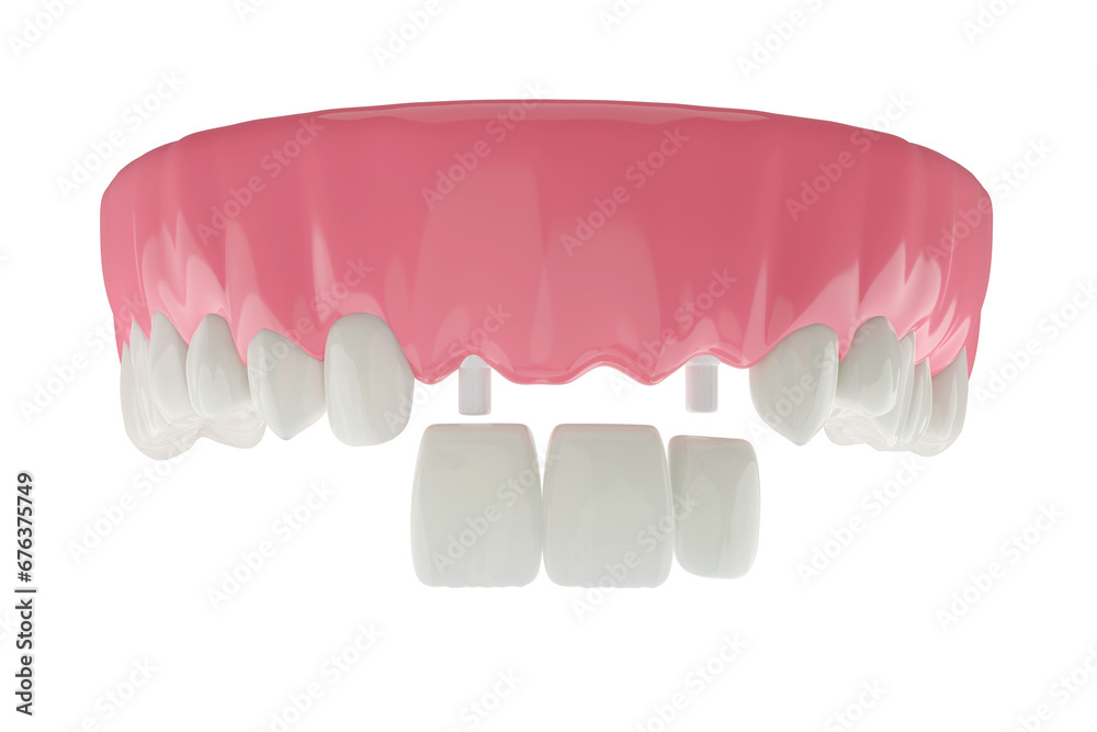 Dental front teeth crowns isolated white background. 3D rendering ...