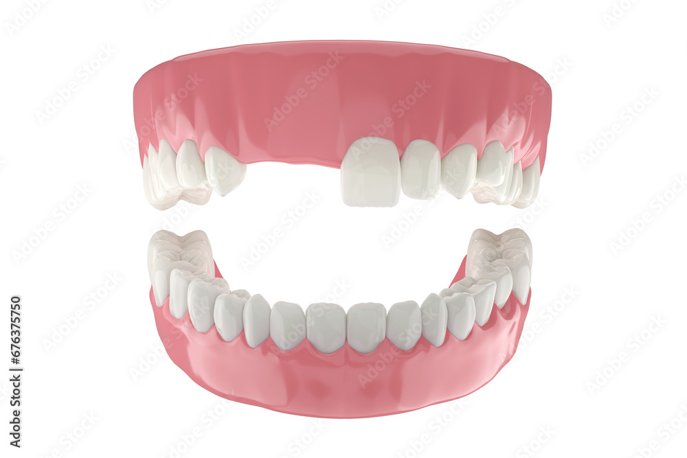Missing front teeth with full tooth and gums isolated white background ...