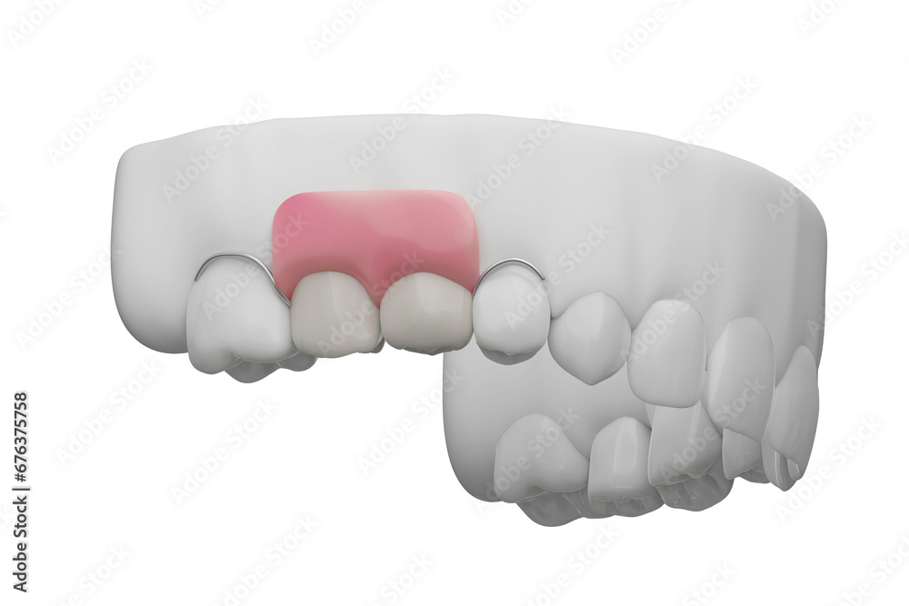 Dentures, false molar tooth with gums isolated white background, 3D ...