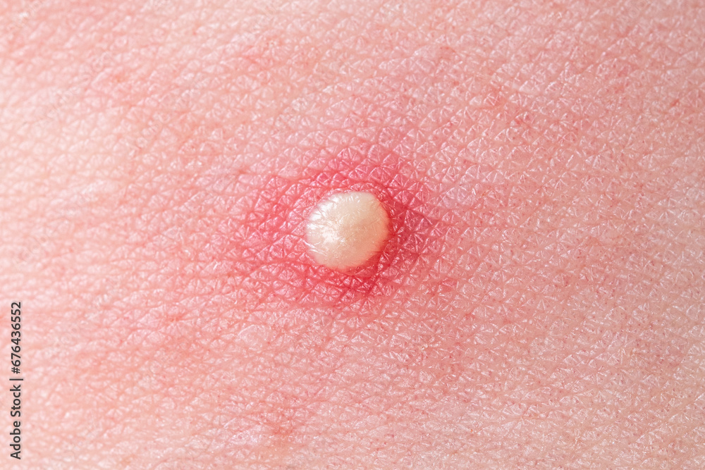 Pimple, acne or comedones. Inflamed pimples, pustules, cysts. Infection ...