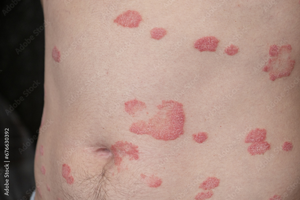 Foto de Psoriasis Vulgaris, skin patches are typically red, itchy, and ...
