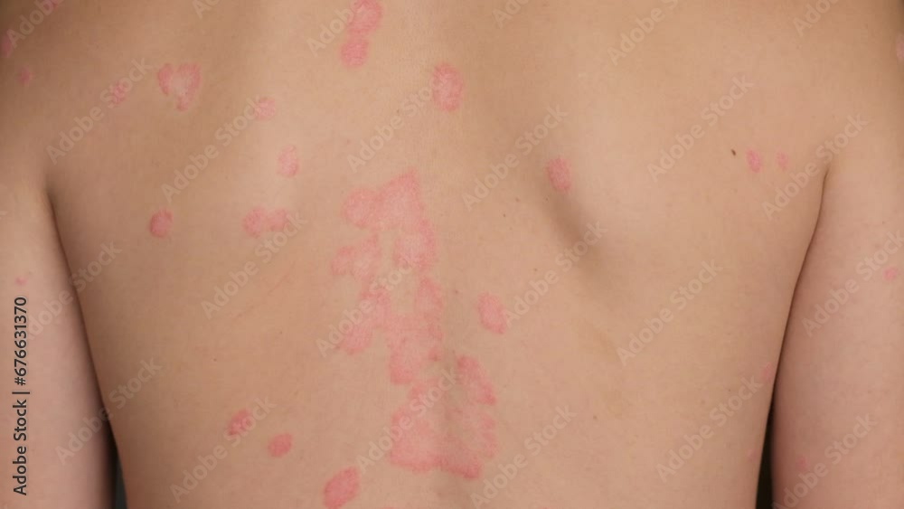 Psoriasis Vulgaris, skin patches are typically red, itchy, and scaly ...