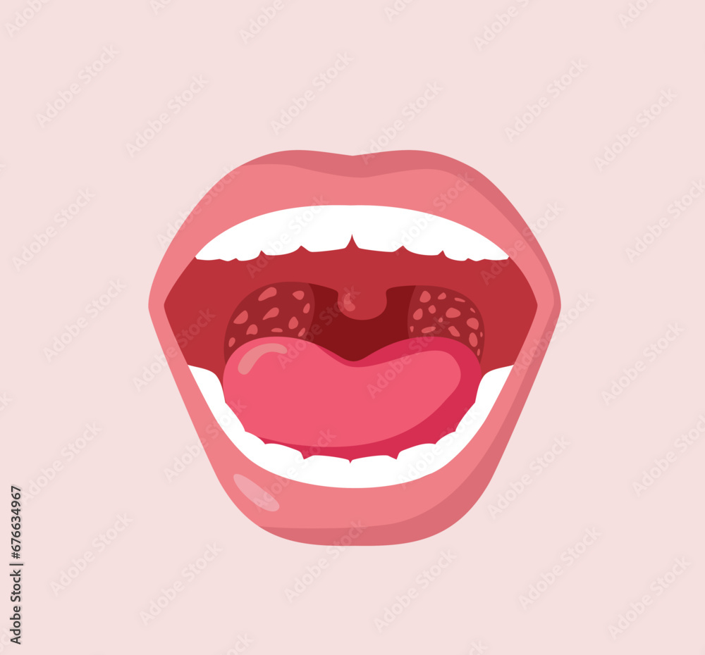 Tonsils inflammation Vector Concept Image of an Open Mouth. Medical ...